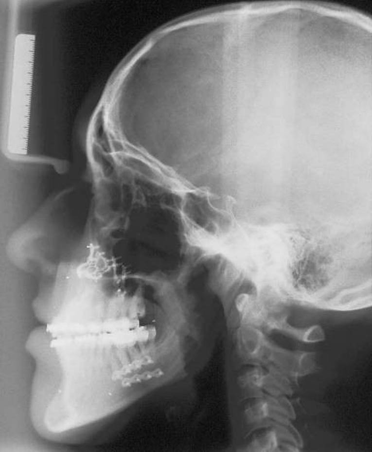 Resorbable versus Titanium Plates for Orthognathic Surgery | University ...