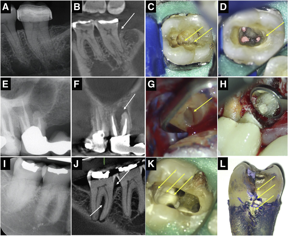 CBCT Patterns of Bone Loss and Clinical Predictors for the Diagnosis of ...